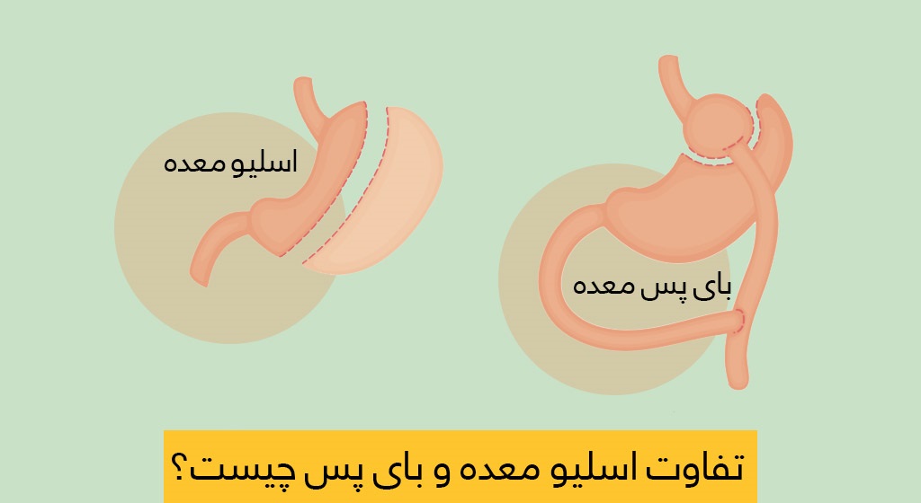 تفاوت اسلیو و بای پس معده چیست؟ تمام نکات مهم